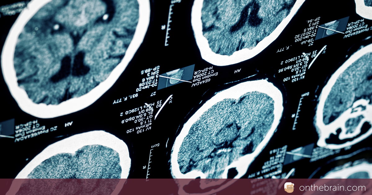 "WAR'S NEW WOUNDS. A shock wave of brain injuries" - "On the Brain ...